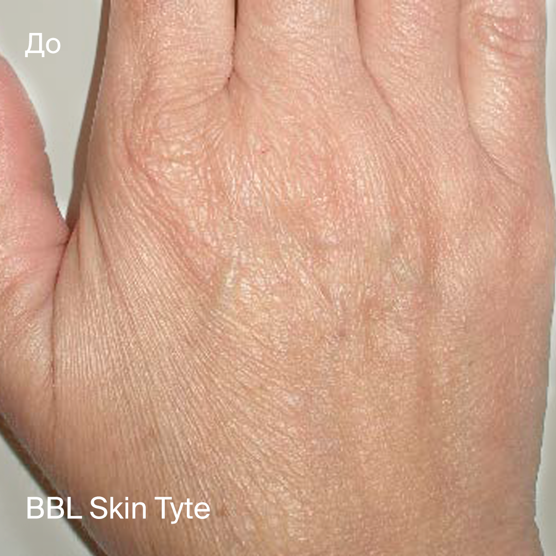 BBL - процедура фототерапии по цене от 12000 руб. в Москве в клинике ...