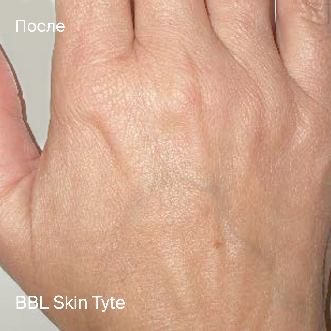 BBL - процедура фототерапии по цене от 12000 руб. в Москве в клинике ...