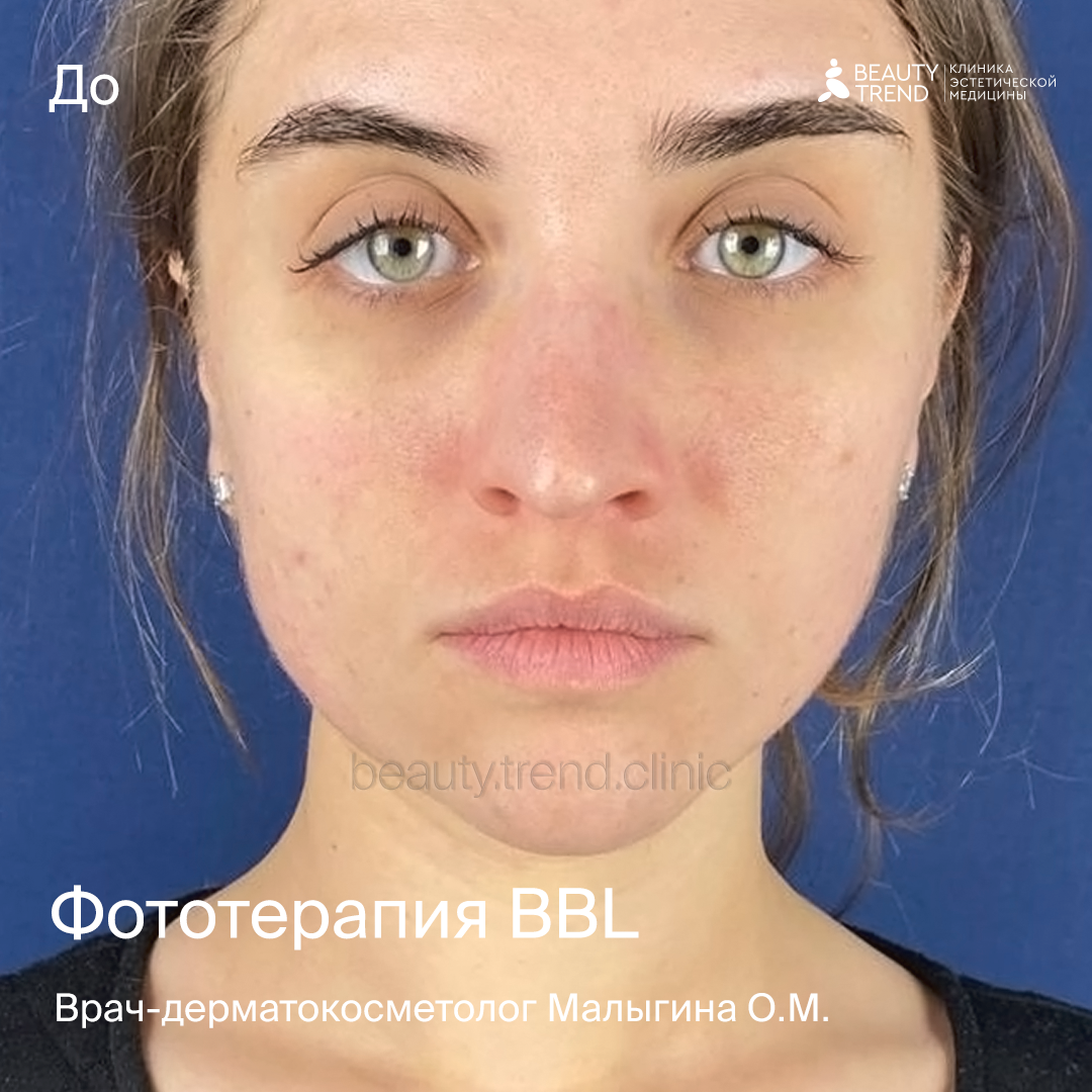 BBL - процедура фототерапии по цене от 12000 руб. в Москве в клинике ...